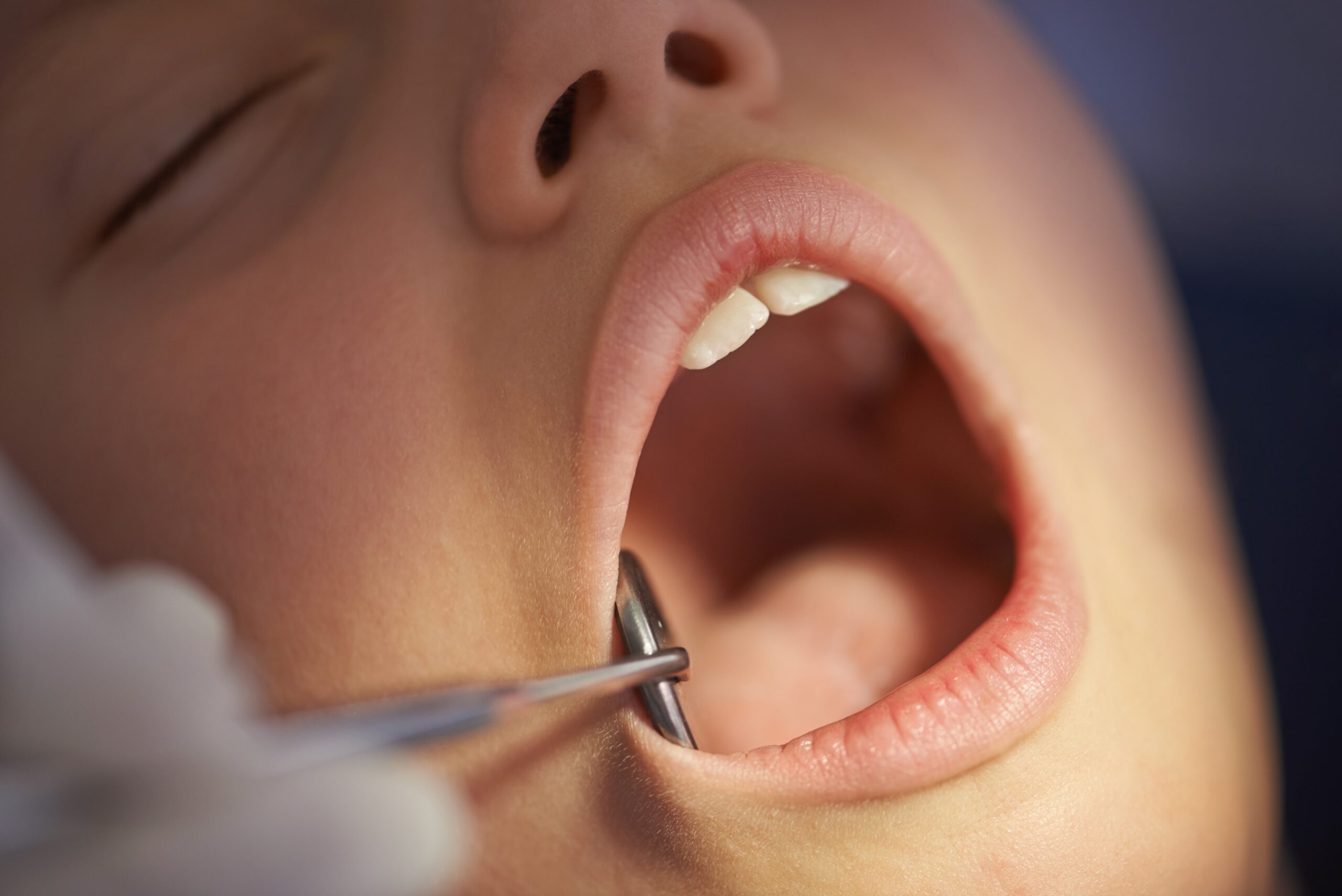 Understanding Submucous Cleft Palate | Calgary, AB